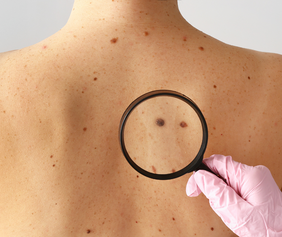 Mole Scanning: Early Detection Improves Outcomes And Saves Lives ...